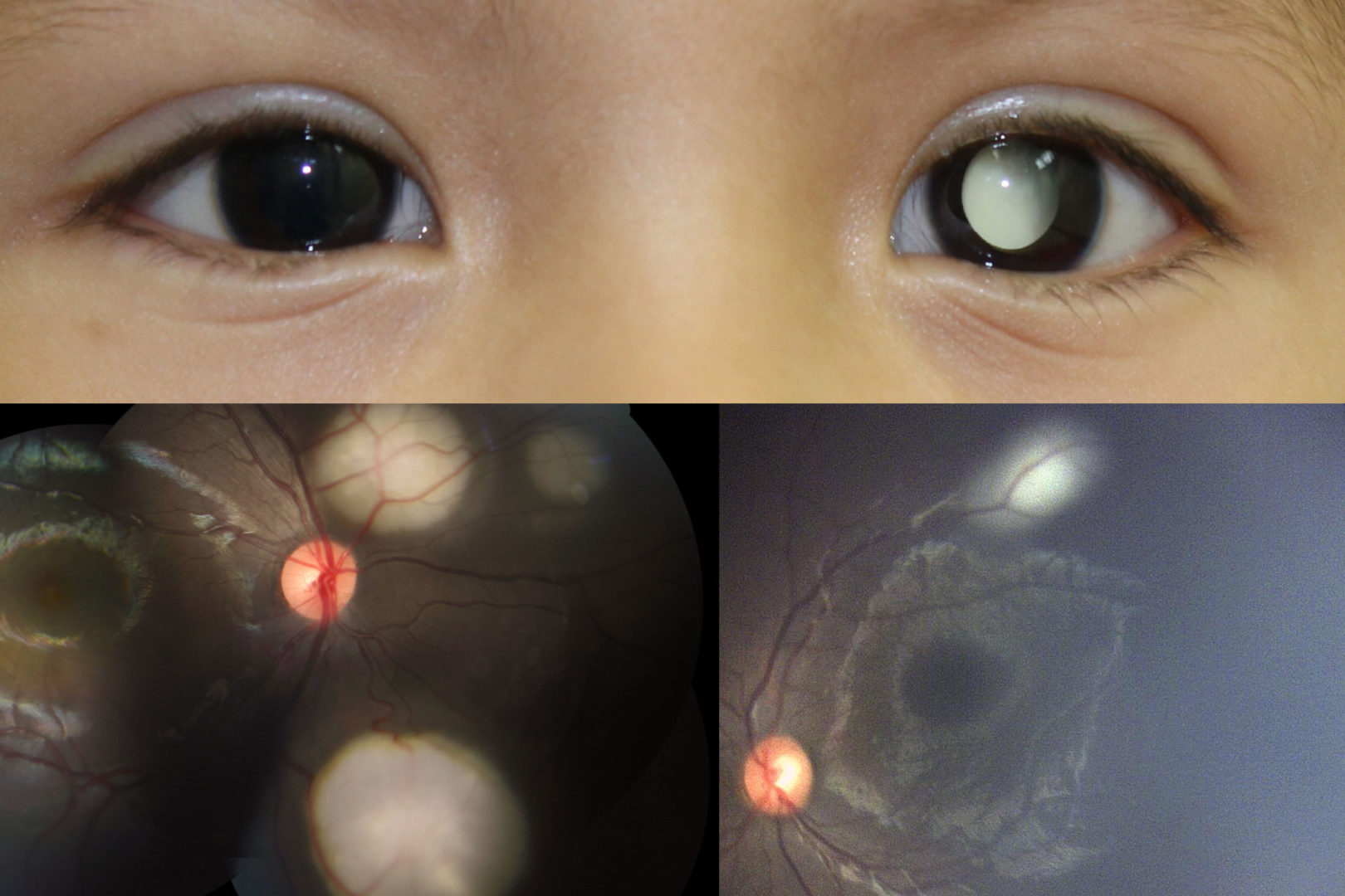 Tumores del Ojo · Oftalmoclinicas